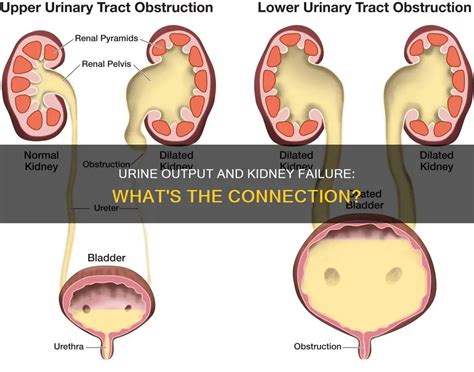 Urine Output And Kidney Failure What S The Connection MedShun