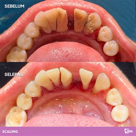 Teeth Scaling Dr Fatain Dental Clinic