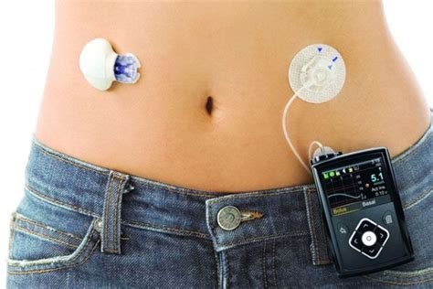 Top 8 gadgets for diabetes that can come in handy | HealthSpectra.com