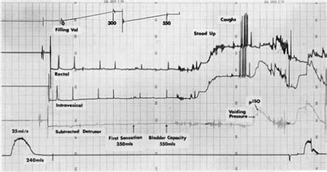 Graphical Illustration Showing The Urodynamic Study Download Scientific Diagram