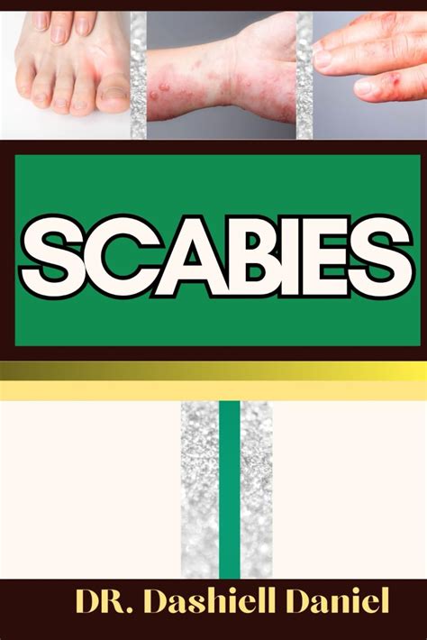 Scabies Expert Guide To Understanding Scabies Causes Symptoms Preventing Treatment For