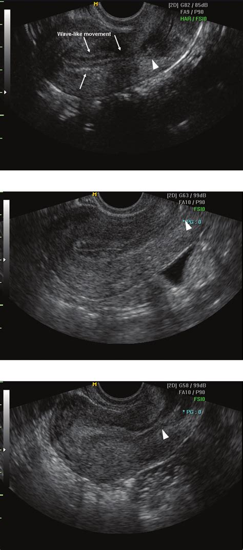 What Is An Endometrium Ultrasound Oaxr