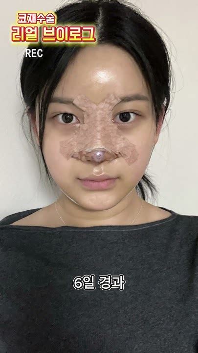 코재수술 리얼 브이로그 📌shorts Youtube