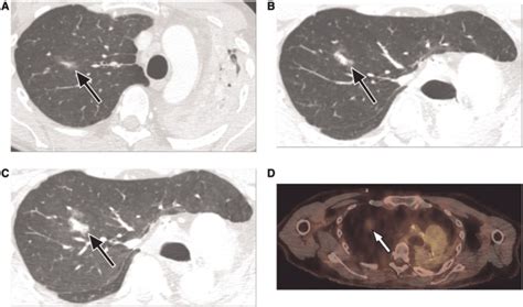 Incidental Subsolid Pulmonary Nodules At Ct Etiology And Management Pmc