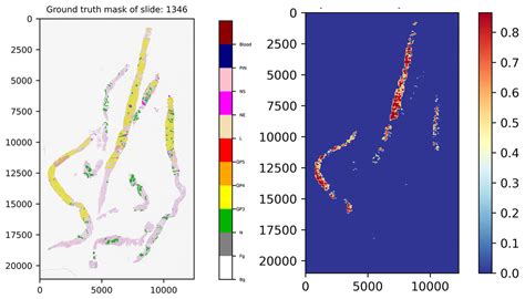 Binary Semantic Segmentation For Detection Of Prostate Adenocarcinoma Using An Ensemble With