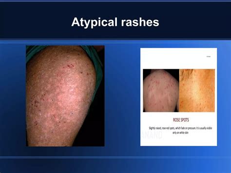 Rash Differential Diagnosis Of Infectious Diseases PPT