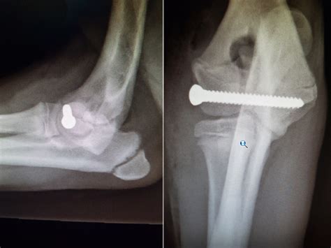 Intercondylar Fracture Dr Michalis Pelekanis