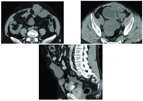 Contrast Enhanced Ct Scan Axial View A B And Sagittal View C Case Download Scientific