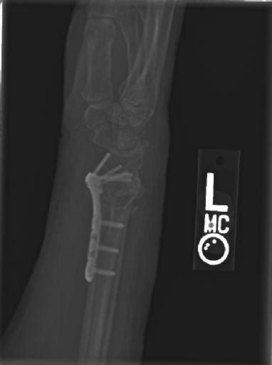 Bone Fracture Detection Object Detection Model V3 V3 By Veda