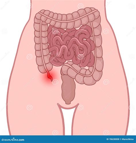 Appendicitis Inflammation Of The Appendix Colon The Illustration On