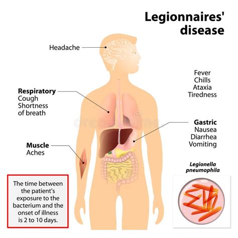 Enfermedad De Legionarios O Legionellosis Ilustración Del Vector