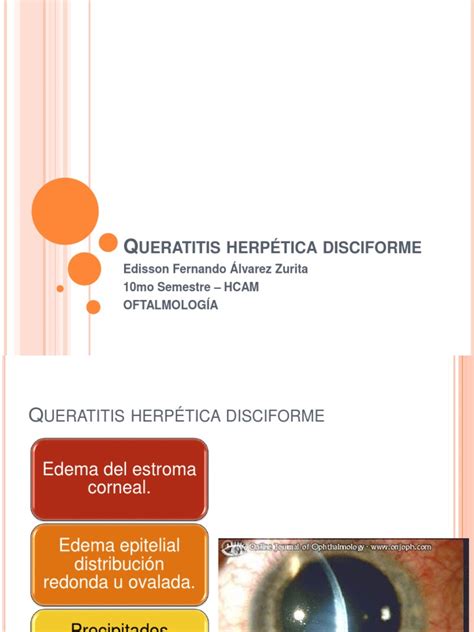 Queratitis Herpética Disciforme Pdf