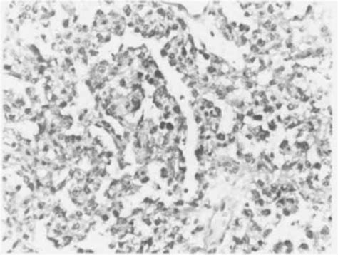 Cuboidal Cells Of Endodermal Sinus Tumor Grow In A Characteristic Download Scientific Diagram