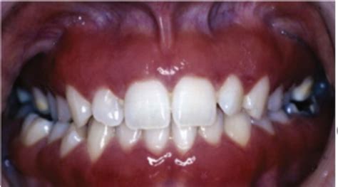 Classification Of Periodontal Diseases Gingivitis Flashcards Quizlet