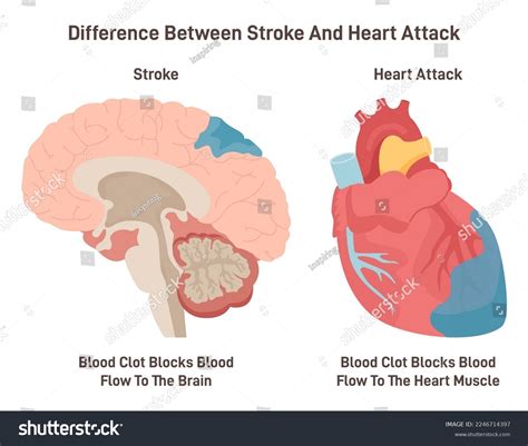 Stroke Heart Attack Plaque Develops On Stock Vector Royalty Free 2246714397 Shutterstock