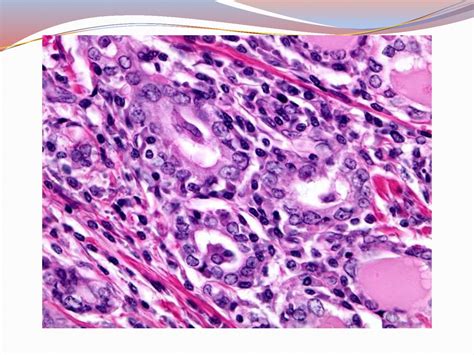 Тиреоидиты Классификация презентация онлайн