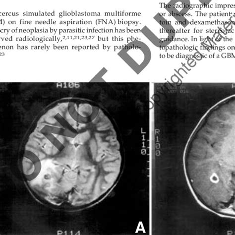 Cranial Magnetic Resonance Scans A Before And B After The Download Scientific Diagram