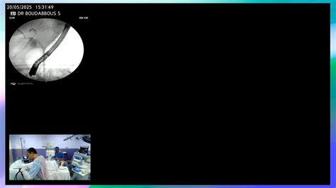 Ercp For Acute Cholangitis Youtube