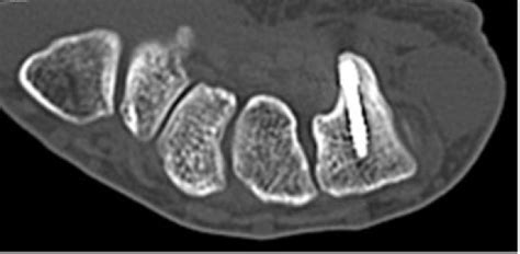 Hook Of Hamate Fracture Hand Orthobullets