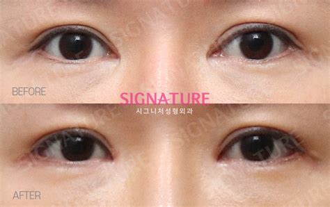 듀얼트임 재수술 전후사진 시그니처성형외과