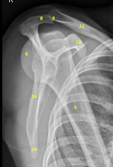 File Shoulder Annotated X Rays Radiopaedia 45952 50274 Lateral Scapular Y View 1  Nc