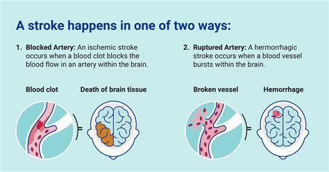 What To Do If Someone Is Having A Stroke Mass General Brigham