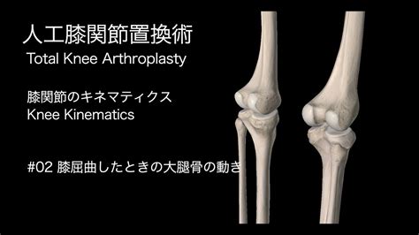 【医学】人工膝関節置換術・膝屈曲したときの大腿骨の動き Youtube