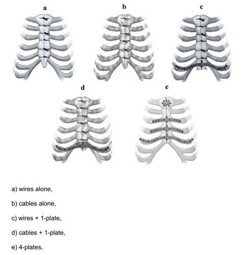 Pictorial Representation Of The Five Different Sternal Closure Download Scientific Diagram