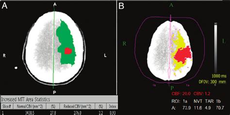 Ctp Analysis Results Of A 40 Year Old Woman With Infarct In The Left Download Scientific