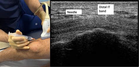 Iliotibial Band Friction Syndrome Cortisone Injection Musculoskeletal Ultrasound And Injections