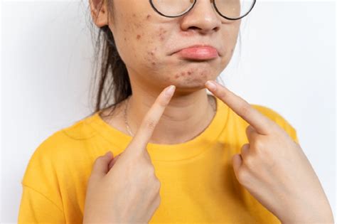 여드름 이소티논 먹으면 바로 해결 당신의 건강가이드 헬스조선