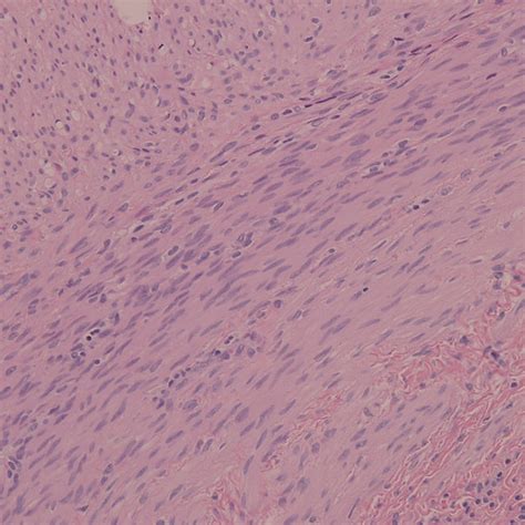 There Were No Identifiable Ganglion Cells On Permanent Section Of The