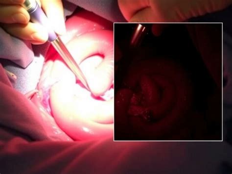 Laparoscopic Appendectomy Procedure Benefits And Recovery Guide