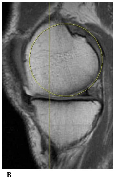 Figure 2 From Relationship Of The Posterior Femoral Axis Of The
