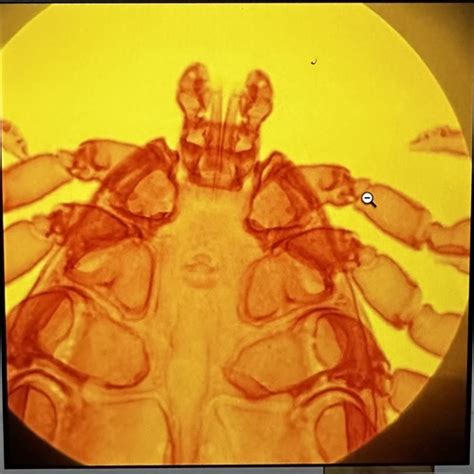 Disease Of The Week 1 6 Flashcards Quizlet