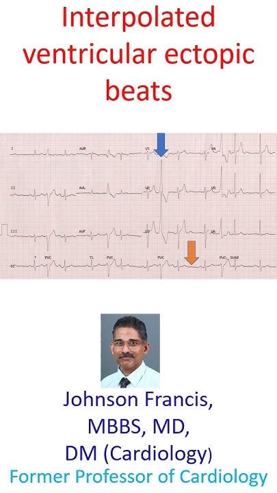 Interpolated Ventricular Ectopic Beats Youtube