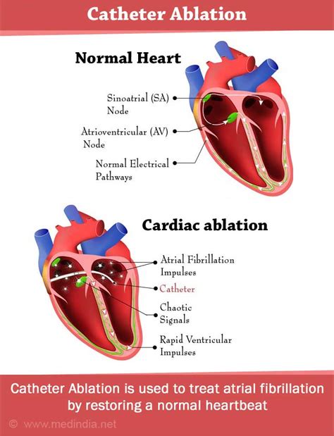 Primary Prevention Atrial Fibrillation Ablation Flutter Memphislasoo