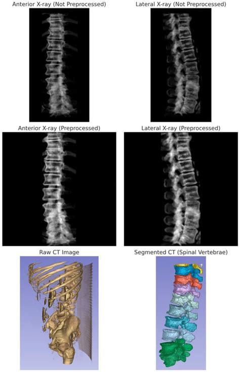 Synthetic 3d Spinal Vertebrae Reconstruction From Biplanar X Rays