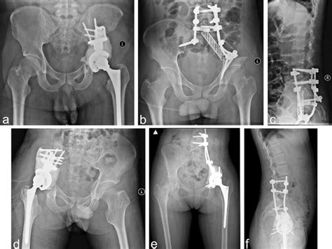 Different Reconstruction Methods Based On The Resection Type Of The