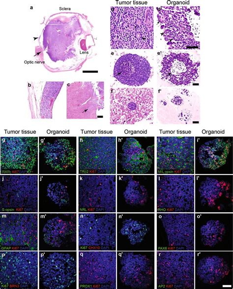 Reproducible Cellular Features And Contents Of The Retinoblastoma In Download Scientific