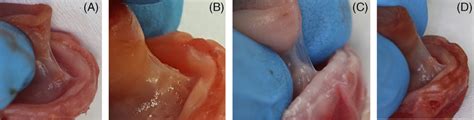 Lingual Frenulum Under Tension With Tongue Elevated Prior To Download Scientific Diagram