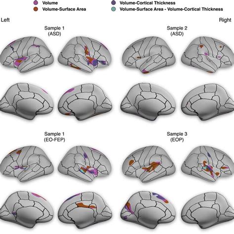 spatial overlap between decreases in cortical thickness and surface