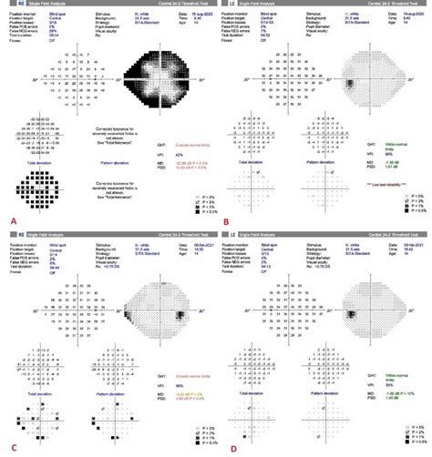 A Humphrey Visual Field Hvf Threshold 24 2 Of The Right Eye Re Download Scientific