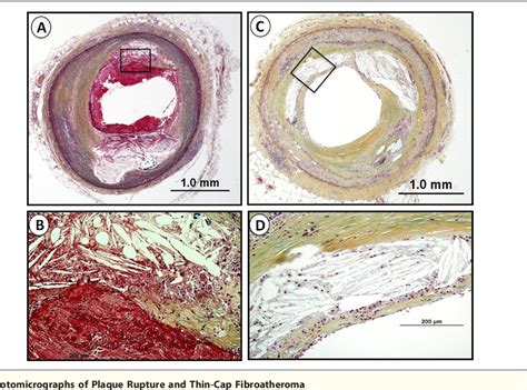 figure 1 from are our tools for the identiﬁcation of tcfa ready and do
