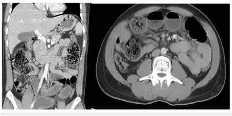 Abrupt Cut Of Small Bowel At Distal Ileum With Dilated Fecal Loaded As Download Scientific