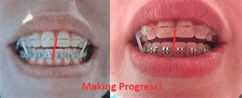 Braces Rubber Bands Triangle Online