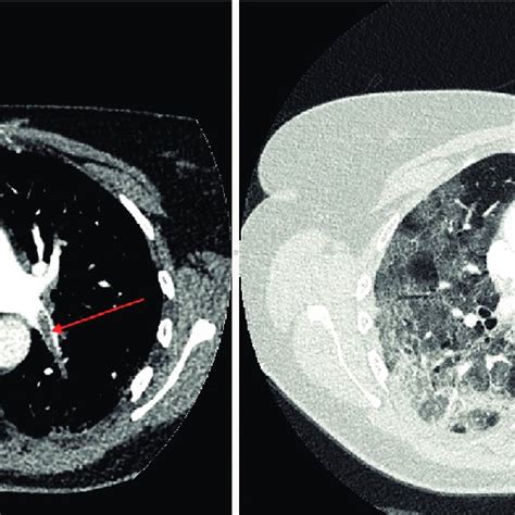 Patchy Consolidation Seen Throughout Both Lungs And Not Confined To The