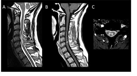 Figure 1 From It Looks Like A Spinal Cord Tumor But It Is Not Semantic Scholar
