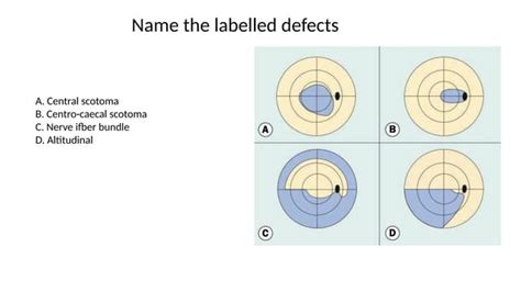 Name The Labelled Vf Defects Visual Field Defects In Optic Neuritis Pptx