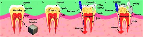 Tooth Structure Loss Resulting From Diabetes Mellitus A Healthy Download Scientific Diagram
